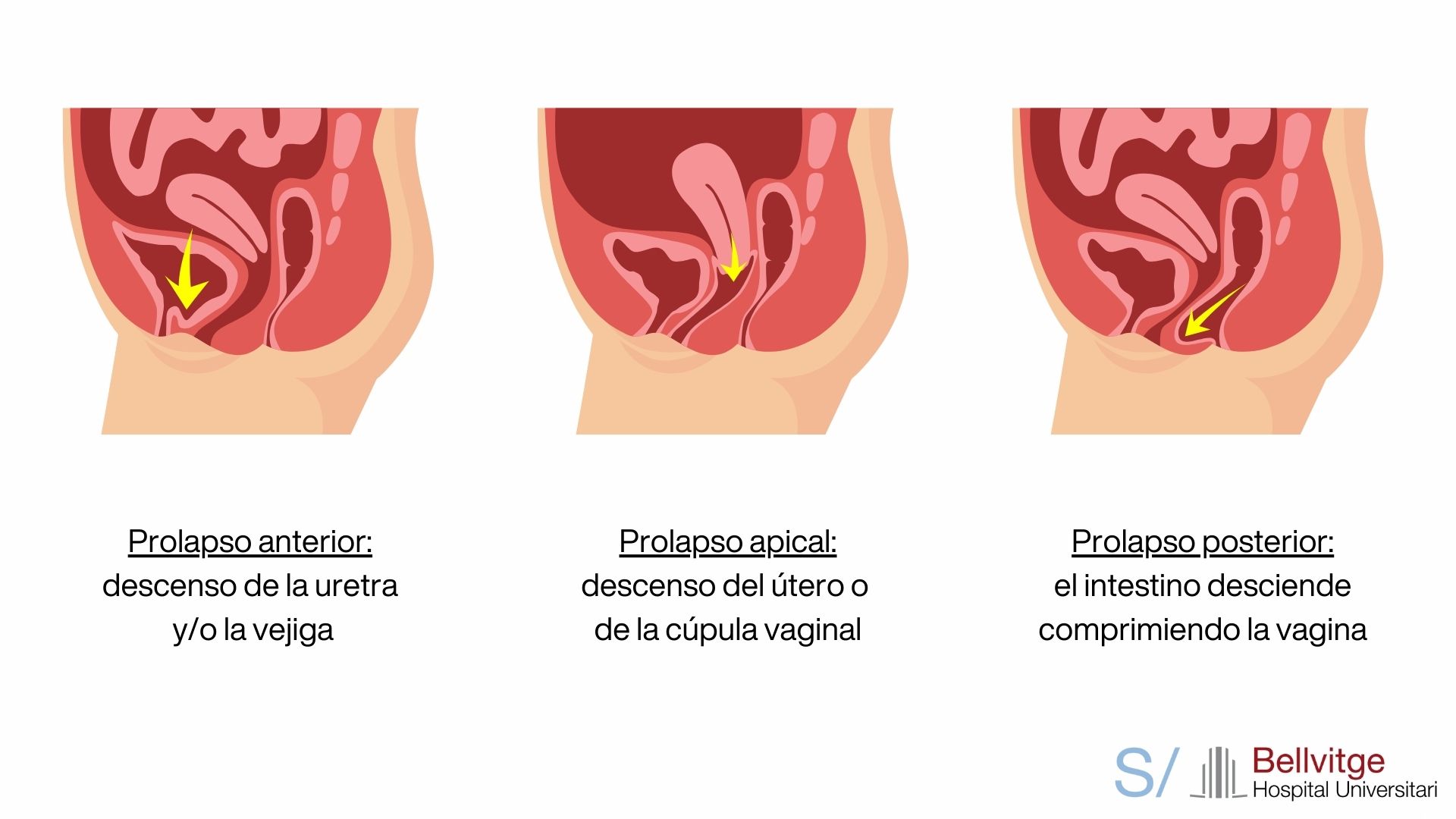 Clasificación Del Prolapso Vaginal